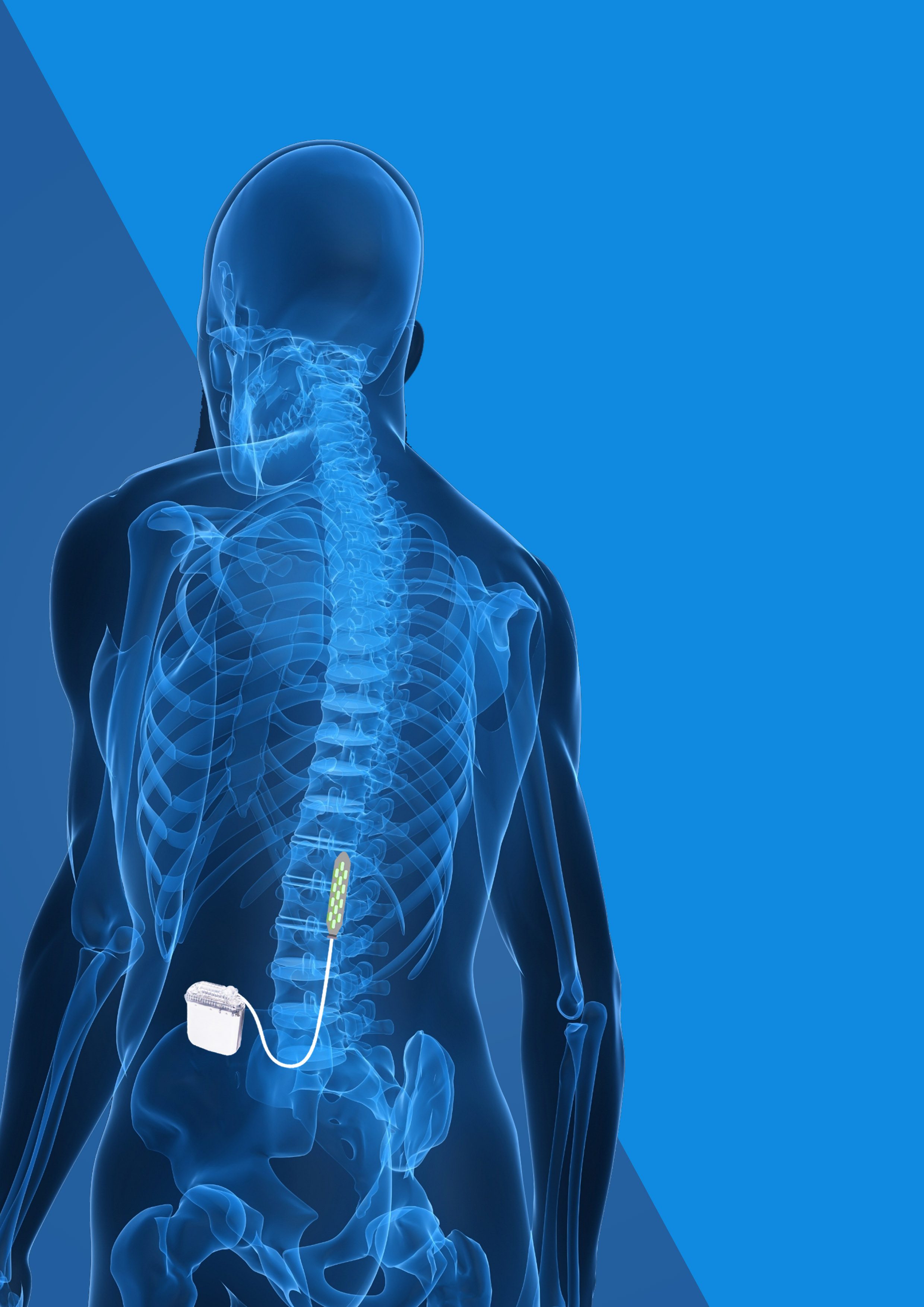 Epidural Stimulation Treatment | For Spinal Cord Injury