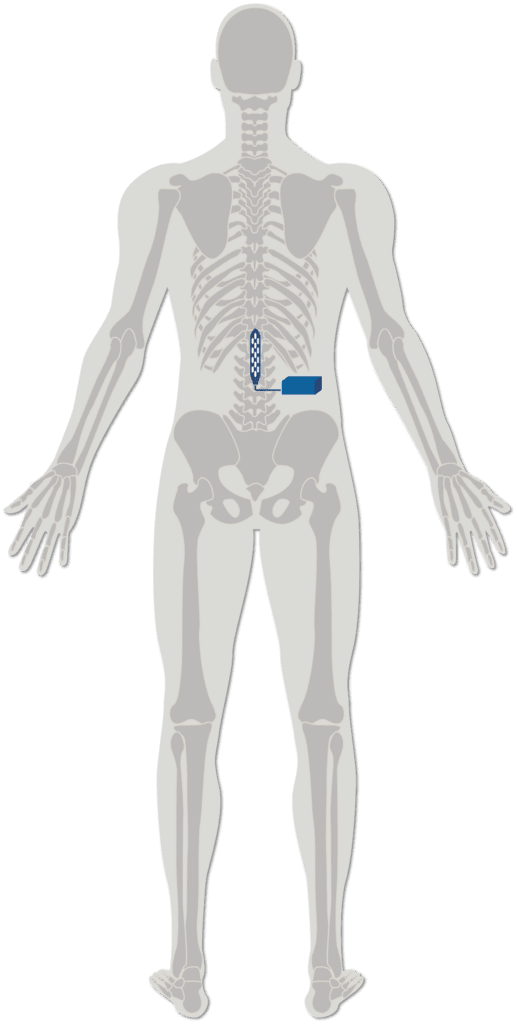Epidural Stimulation Treatment | For Spinal Cord Injury