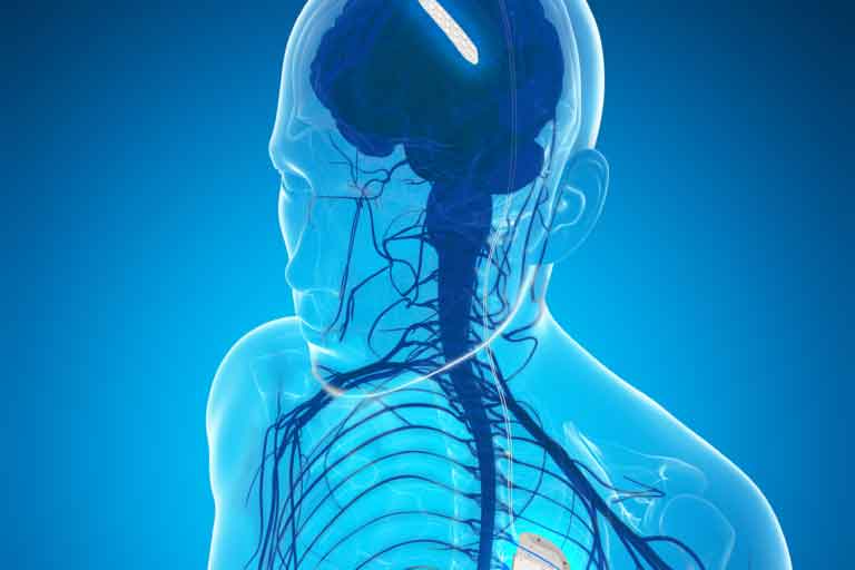 Verita Neuro's Brain Stimulation Treatment | BrainStim